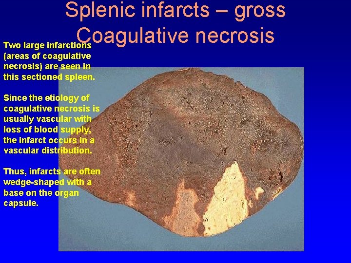 Splenic infarcts gross Coagulative necrosis Two large infarctions