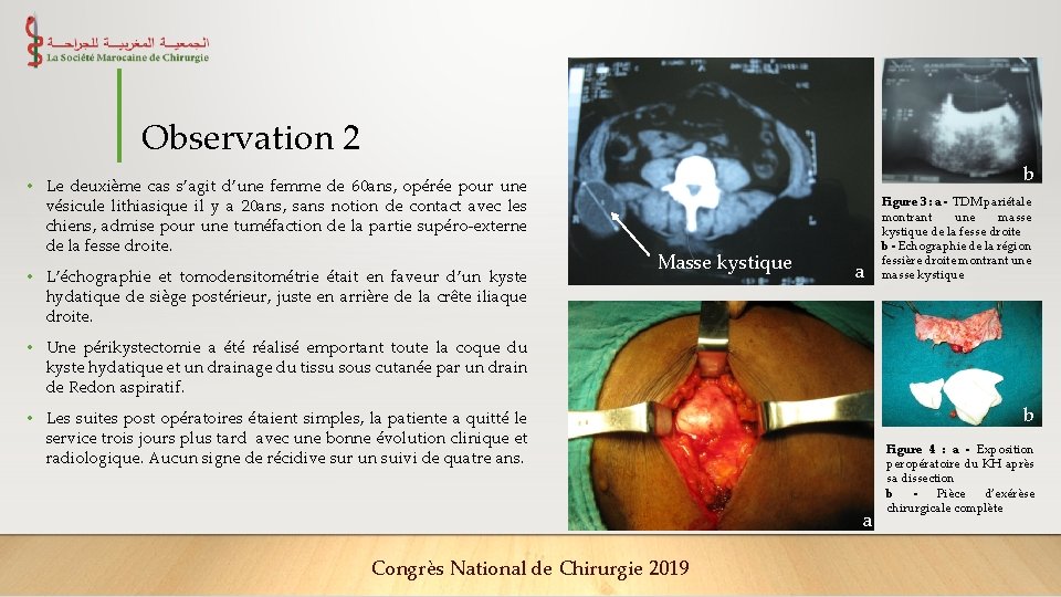 Le kyste hydatique fessier une localisation exceptionnelle propos