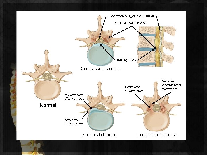 Lumbar Spinal Stenosis KTPH Orthopaedics Spine Teaching Anshuja