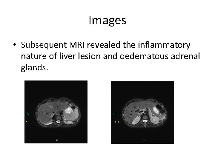 Addisonian Syphilitic Adrenalitis Dr Alhamza AlKhatib Radiology Sp