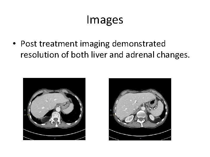 Addisonian Syphilitic Adrenalitis Dr Alhamza AlKhatib Radiology Sp