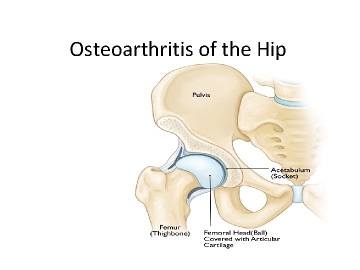 Osteoarthritis of the Hip Osteoarthritis of the Hip