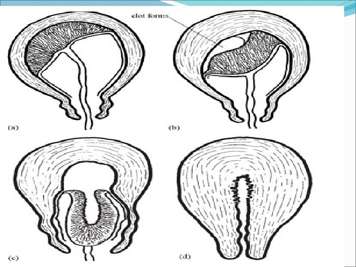 THIRD STAGE OF LABOUR DEFINITION Third stage is