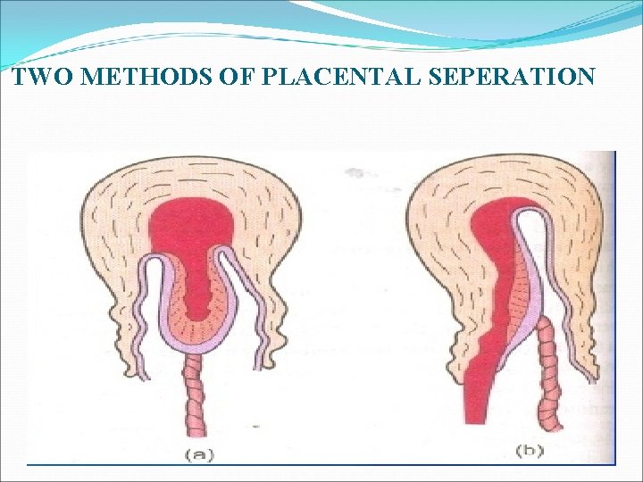 THIRD STAGE OF LABOUR DEFINITION Third stage is