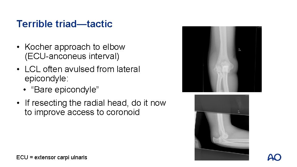Fracture dislocation of the elbow AO Trauma Advanced