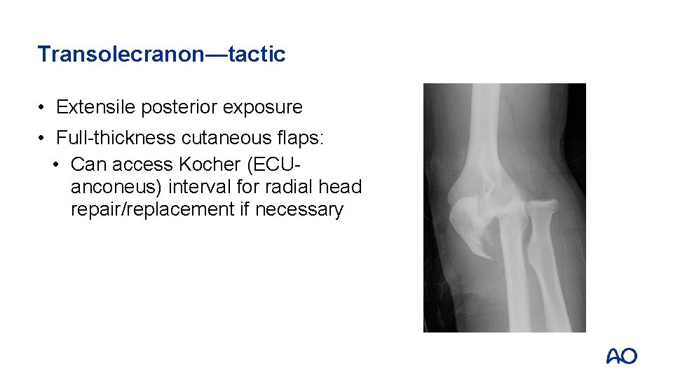 Fracture dislocation of the elbow AO Trauma Advanced