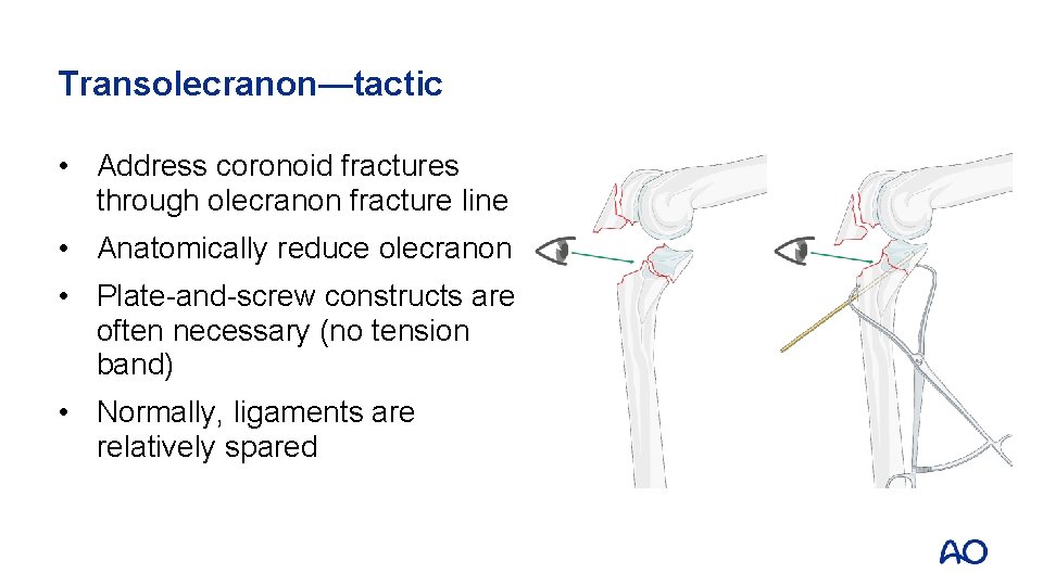 Fracture dislocation of the elbow AO Trauma Advanced
