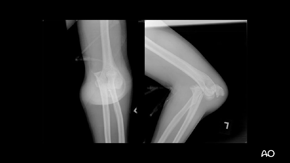 Fracture dislocation of the elbow AO Trauma Advanced
