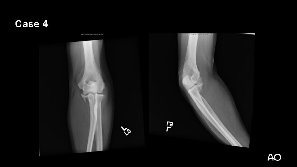 Fracture dislocation of the elbow AO Trauma Advanced