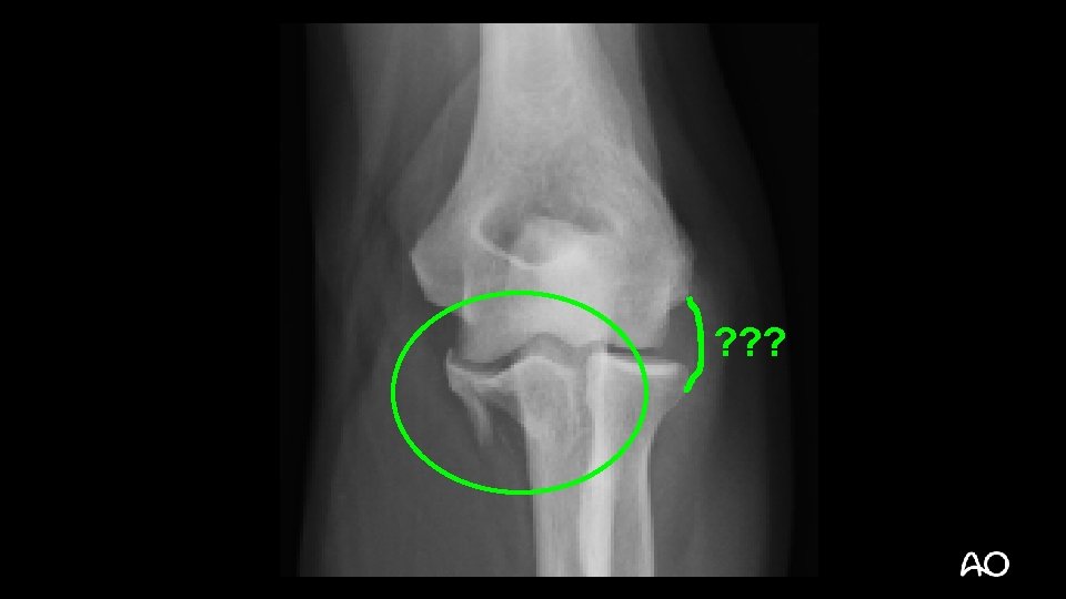Fracture dislocation of the elbow AO Trauma Advanced