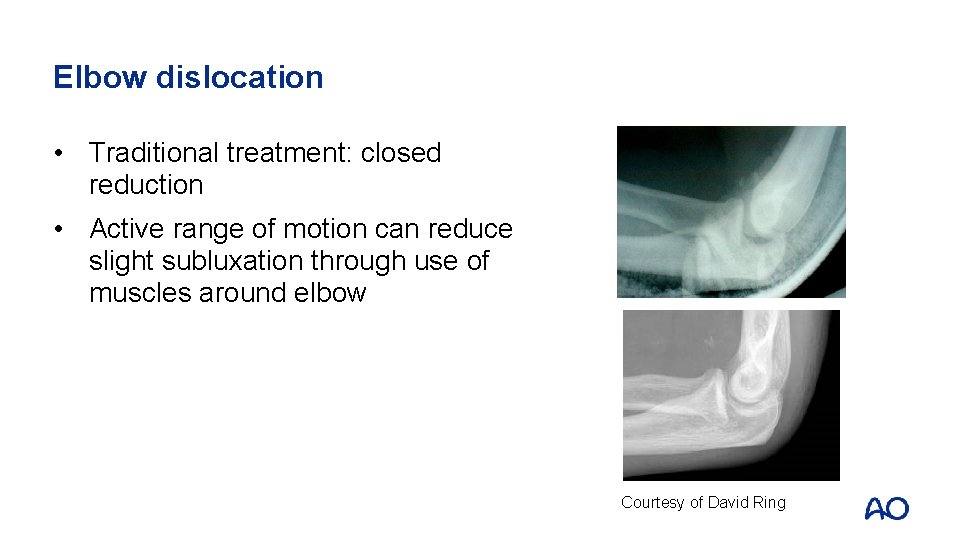 Fracture dislocation of the elbow AO Trauma Advanced