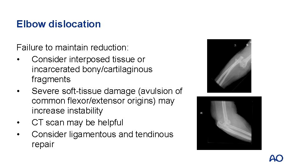 Fracture dislocation of the elbow AO Trauma Advanced