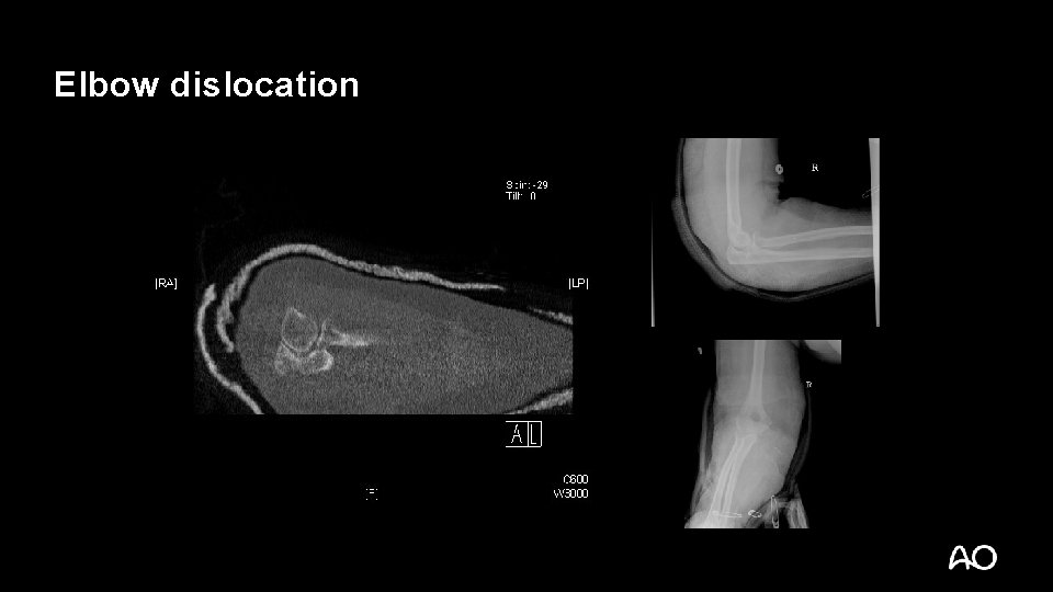 Fracture dislocation of the elbow AO Trauma Advanced