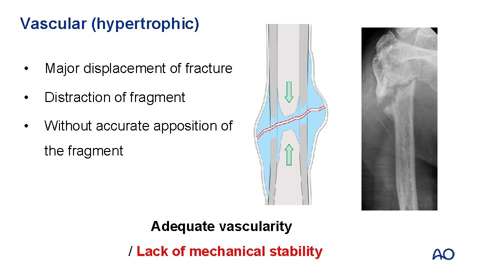 Delayed healingcauses and treatment principles AO Trauma Basic