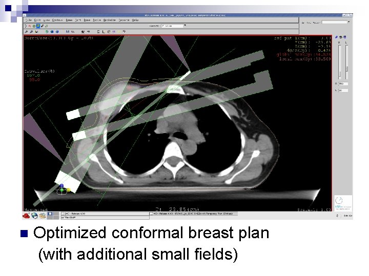 TWO FIELD BREAST PLAN VS OPTIMIZED CONFORMAL BREAST