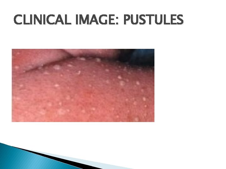 Neonatal sepsis Dr A VASUNDHARA Professor HOD Pediatrics