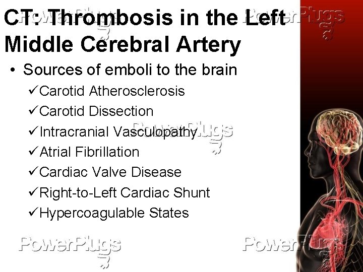 Overview of Stroke Cerebral Infarction A Case Chief