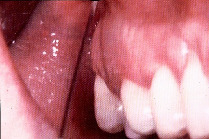 MAXILLARY ANESTHESIA Techniques of Maxillary Anesthesia Local Infiltration