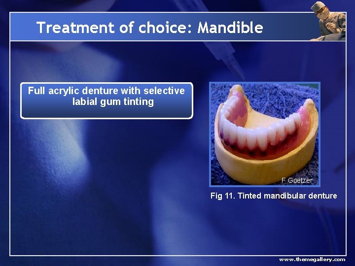 The fabrication of a maxillary and a mandibular