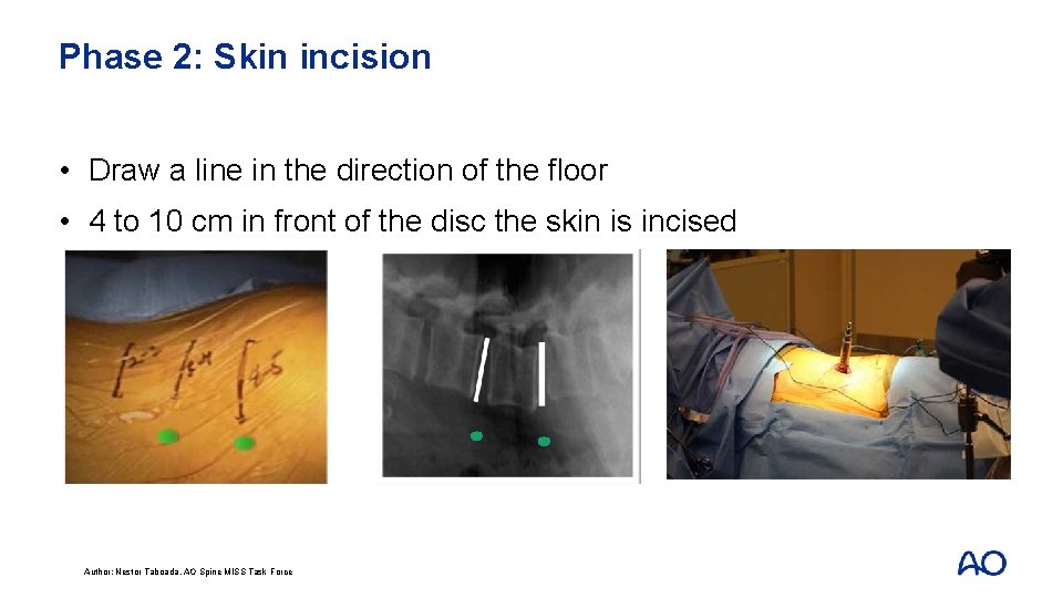 Preanterior lumbar interbody fusion In minimally invasive spine