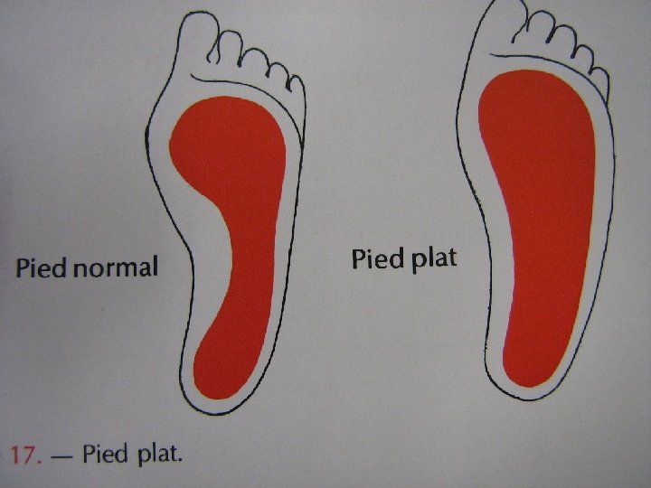SEMIOLOGIE DU PIED Rappel anatomique Trois parties tarse