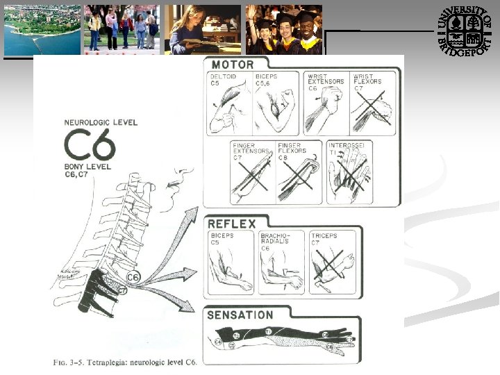 Orthopaedic Neurology Cervical Cord Lesions Tetraplegia Stanley Hoppenfeld