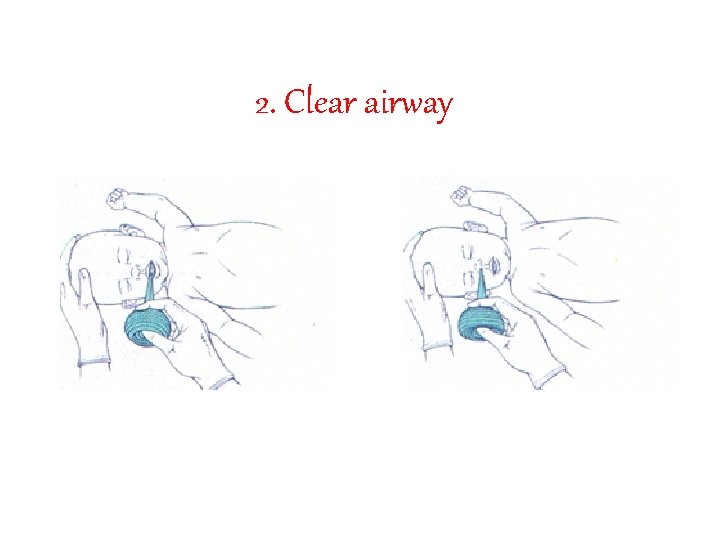 Resuscitation of the newly born Dr Murtada M