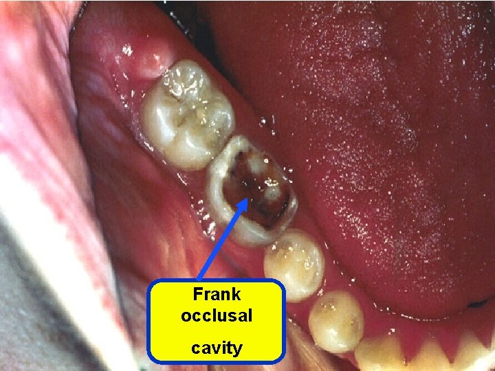 Caries Management and Prevention John D B Featherstone