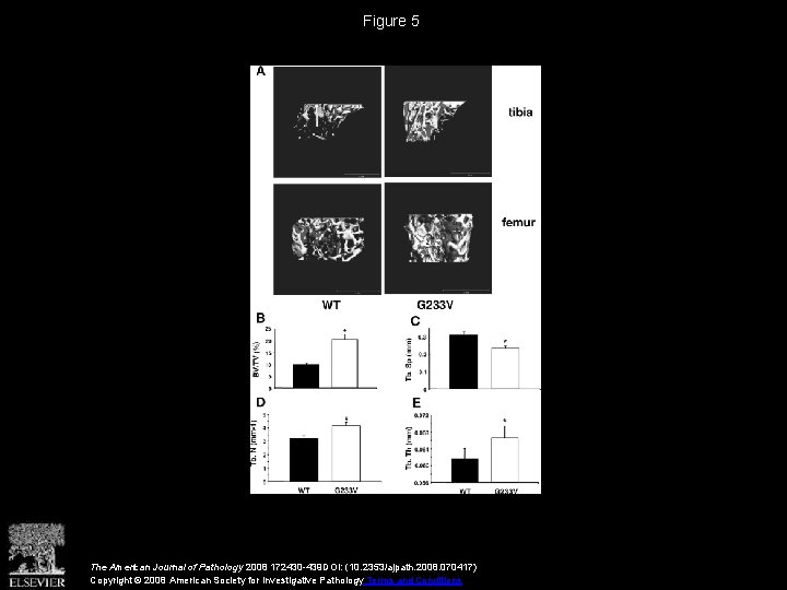 Platelet Dysfunction and a High Bone Mass Phenotype