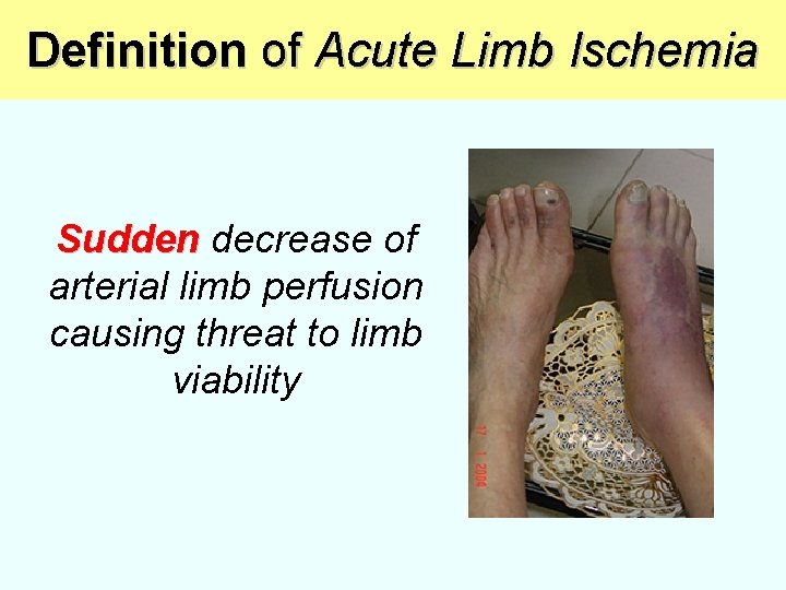 Acute Limb Ischemia Definition Etiology Patophysiology Clinical Evaluation