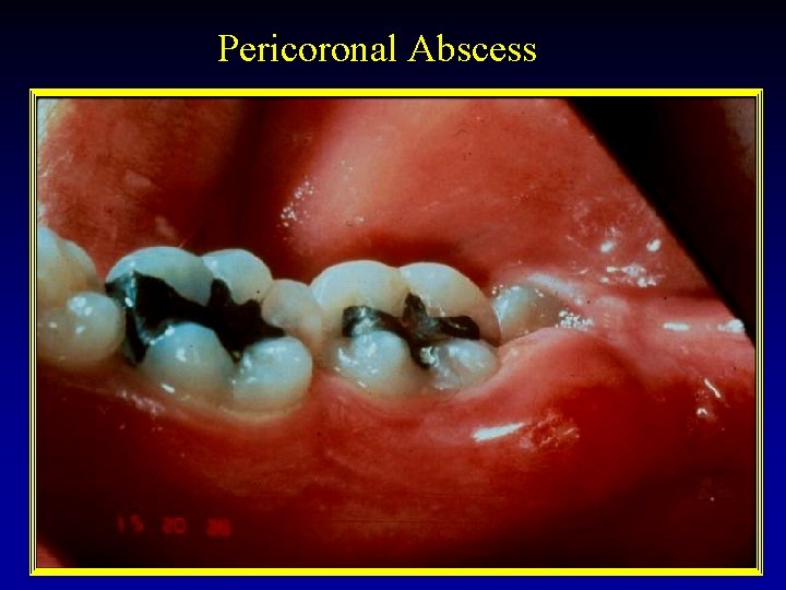 ACUTE PERIODONTAL CONDITIONS Dr shabeel pn OVERVIEW Abscesses