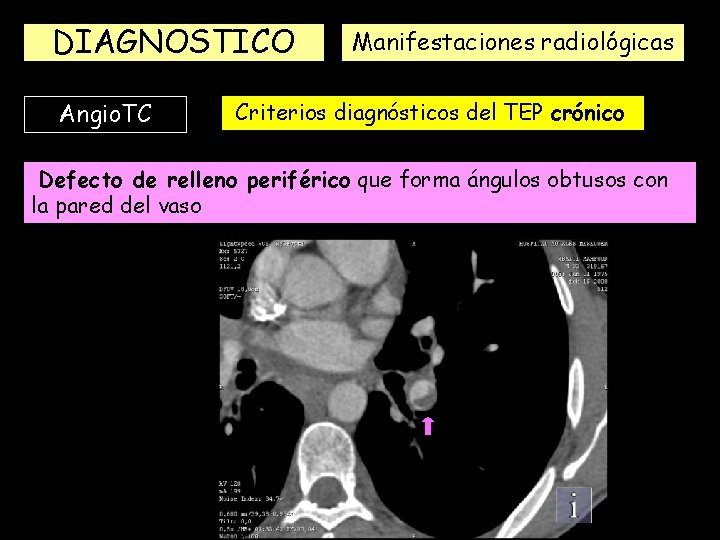 DIAGNOSTICO Angio TC Manifestaciones radiolgicas Criterios diagnsticos del