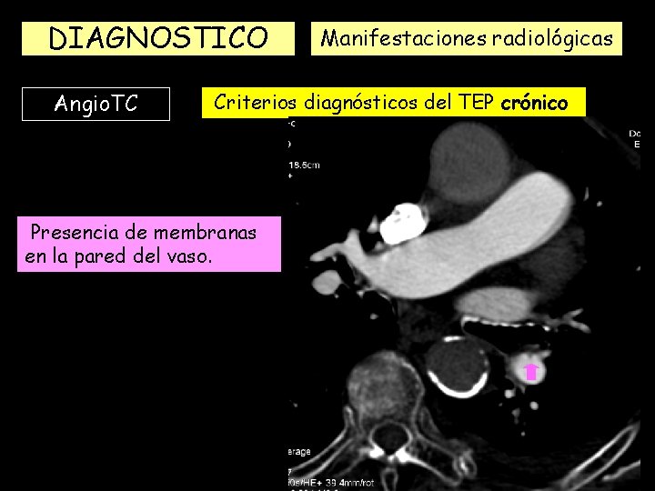 DIAGNOSTICO Angio TC Manifestaciones radiolgicas Criterios diagnsticos del