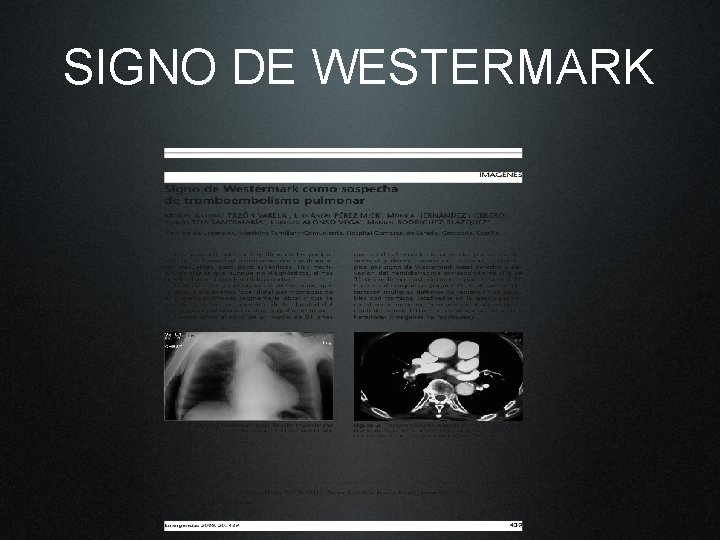 TROMBOEMBOLISMO PULMONAR Dr Guillermo Guevara Ospino HSJD TROMBOEMBOLISMO