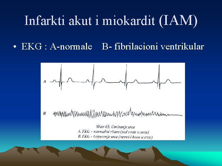 Infarkti akut i miokardit IAM Infarkti akut i