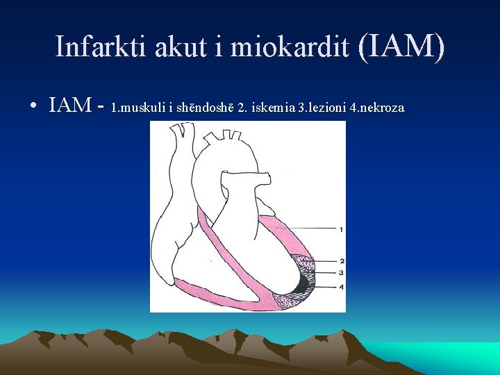 Infarkti akut i miokardit IAM Infarkti akut i