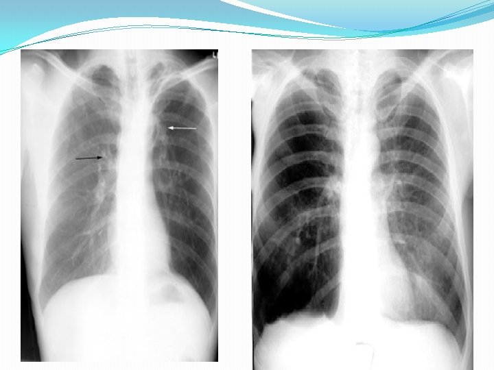 Abnormalities in CXR Presented by Ahmed Ebrahim Elmorsy