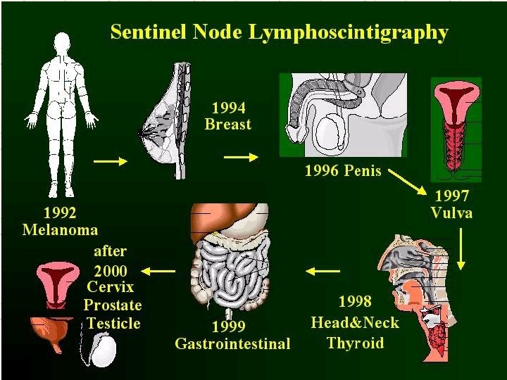 Radiation Safety in Sentinel Node Biopsy Procedures 200416