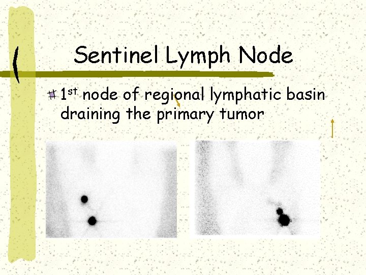 Radiation Safety in Sentinel Node Biopsy Procedures 200416