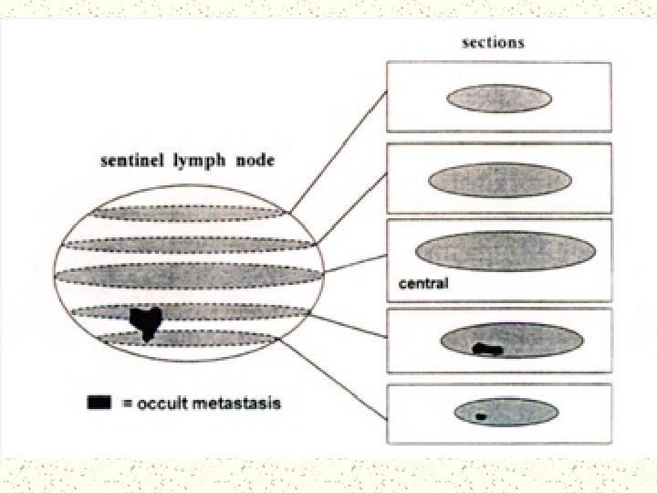 Radiation Safety in Sentinel Node Biopsy Procedures 200416