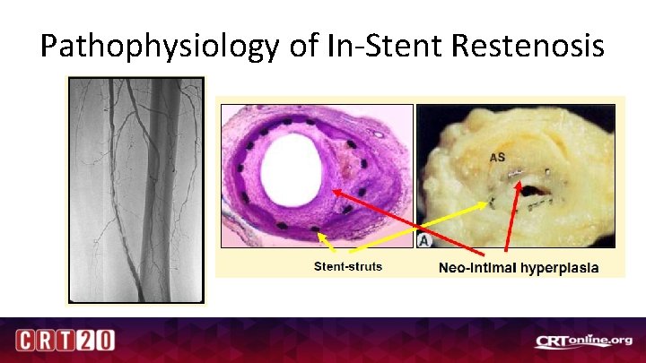 Why we are so excited about DCB for