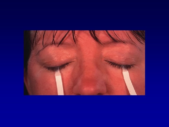 Sjogrens syndrome Sicca syndrome is a systemic autoimmune