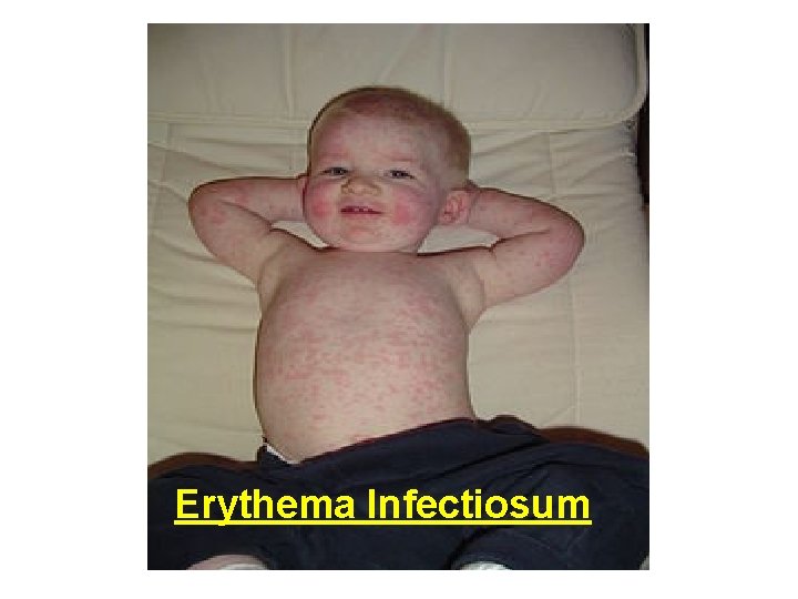 MSS Module Viral Skin Infections Two Lectures By