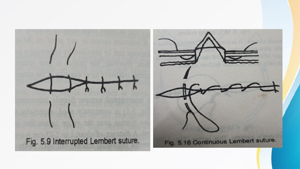SUTURE MATERIAL AND SUTURING TECHNIQUES VI Dr Archana