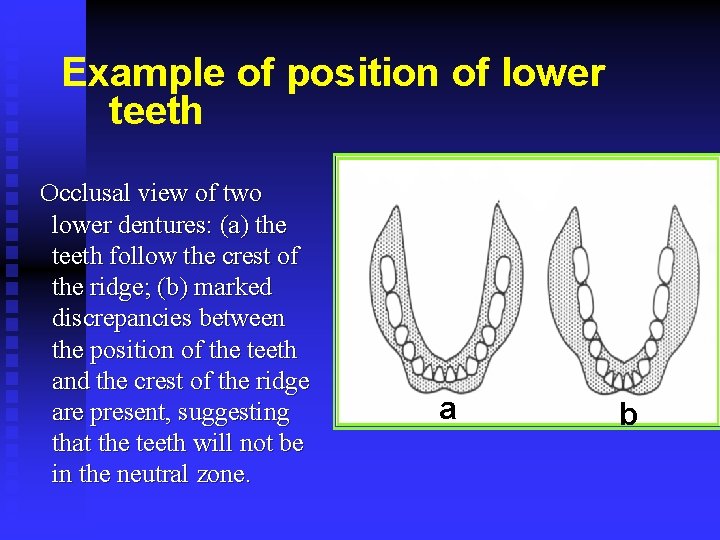 THE TRIAL DENTURE BASE Rola M Shadid BDS