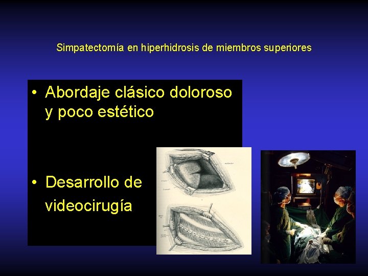 Simpatectoma videotoracoscpica en hiperhidrosis de miembros superiores y