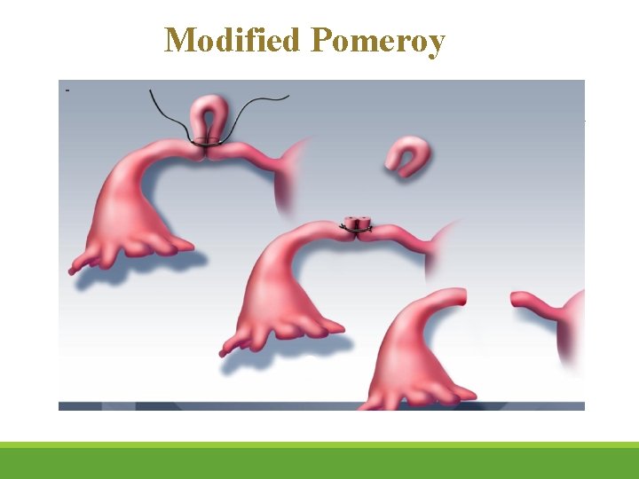 Permanent contraception EVE ESPEY MD MPH OBSTETRICS GYNECOLOGY