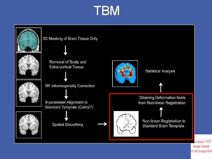 Generalized TensorBased Morphometry TBM for the analysis of