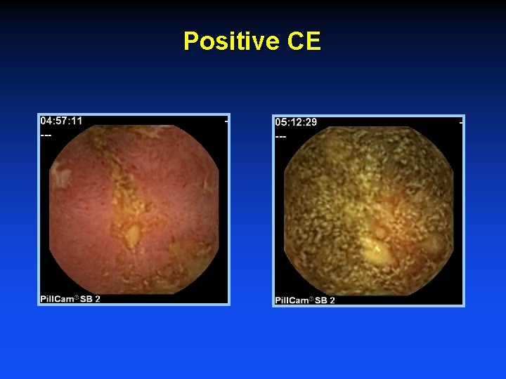 Small Bowel Evaluation Choosing the Best Radiologic and