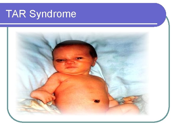 Approach to the newborn with thrombocytopenia Dr Lourdes